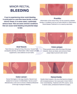 RECTAL BLEEDING - Digestive and Liver Health Specialists
