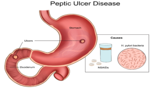 Helicobacter pylori Bacteria - Digestive and Liver Health Specialists