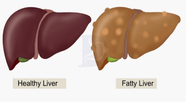 Fatty Liver - Digestive and Liver Health Specialists