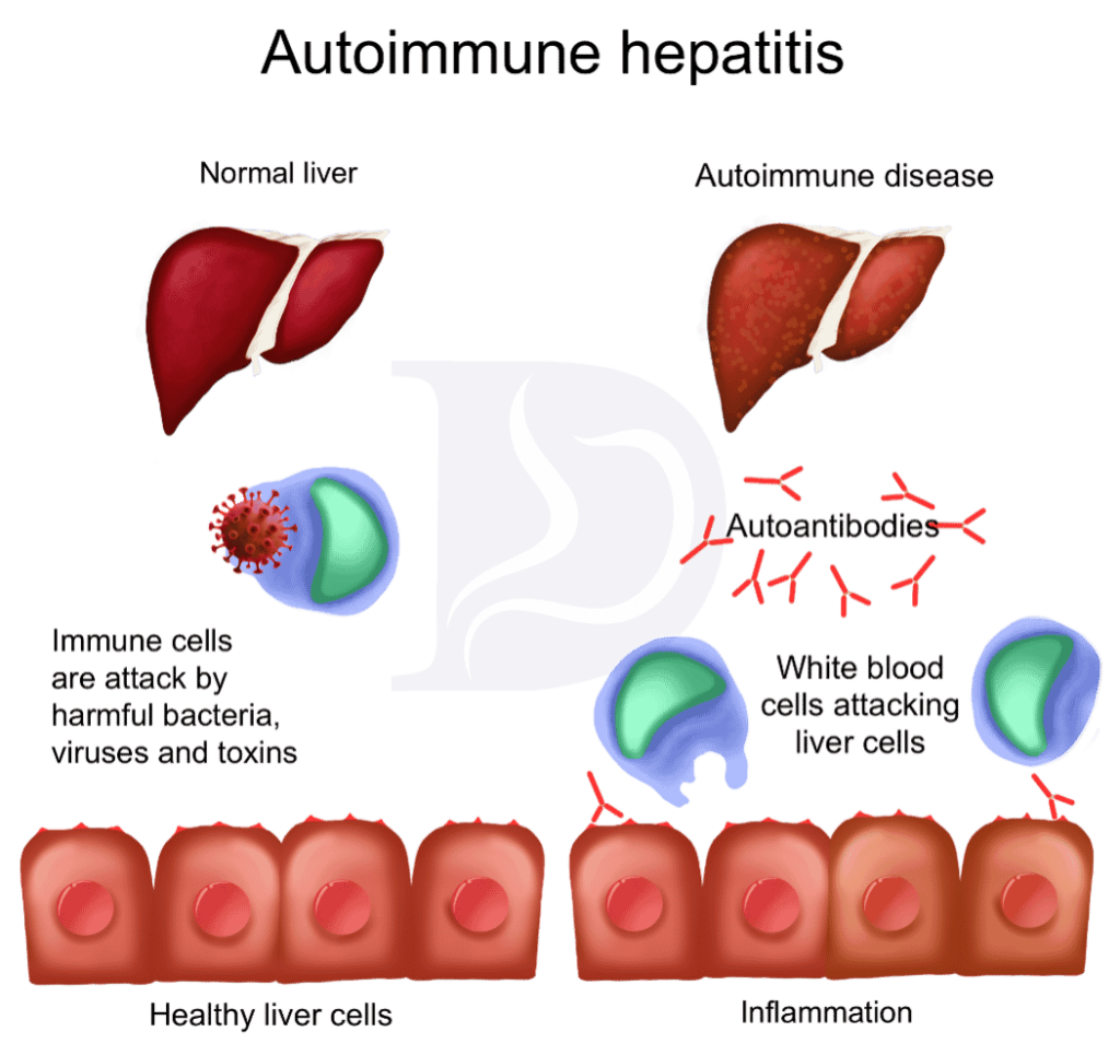 Learn About Autoimmune Hepatitis - The GI Docs